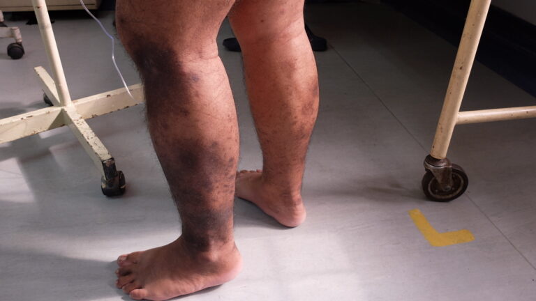 Skin Changes from Vein Disease: Symptoms & Treatment